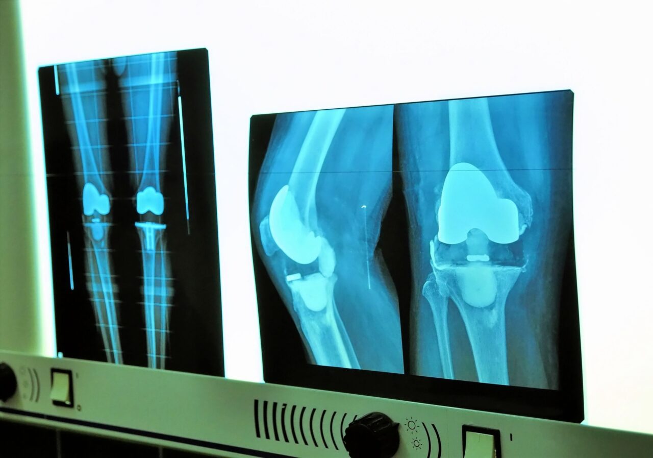 5 Common Myths and Misconceptions About Orthopaedics and Sports ...