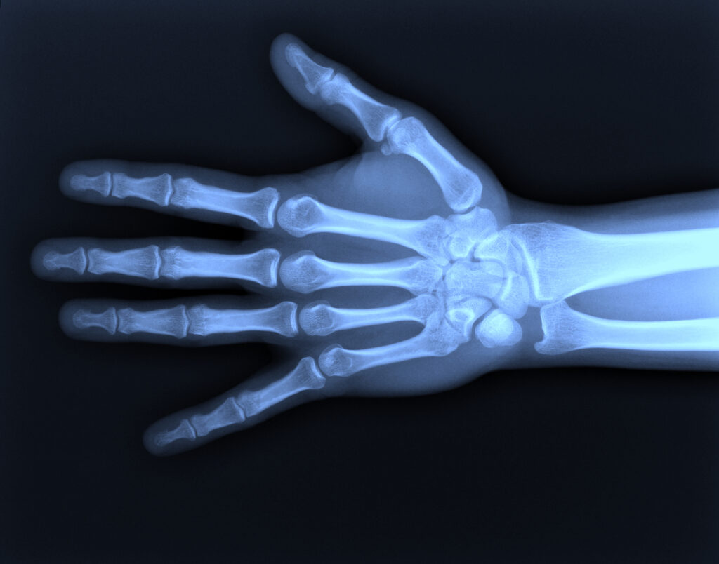 Dupuytrens Contracture & Other Conditions of the Hand - Nebraska ...